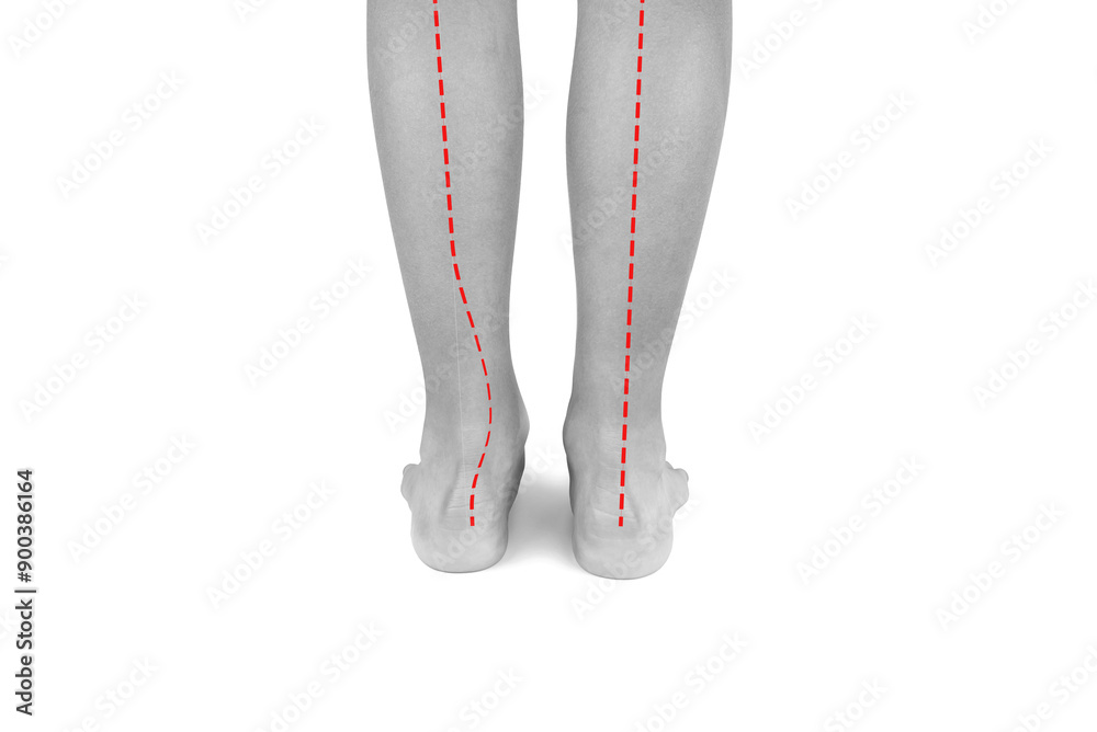 Feet of a boy with flat feet or a dropped arch, the ankle is tilted ...