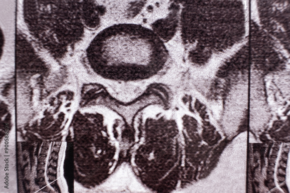 MRI of a patient with intervertebral disc protrusion and ...