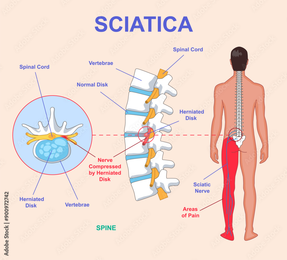 Sciatica medical diagram. Anatomical scheme with human spine, nerves and intervertebral disc ...