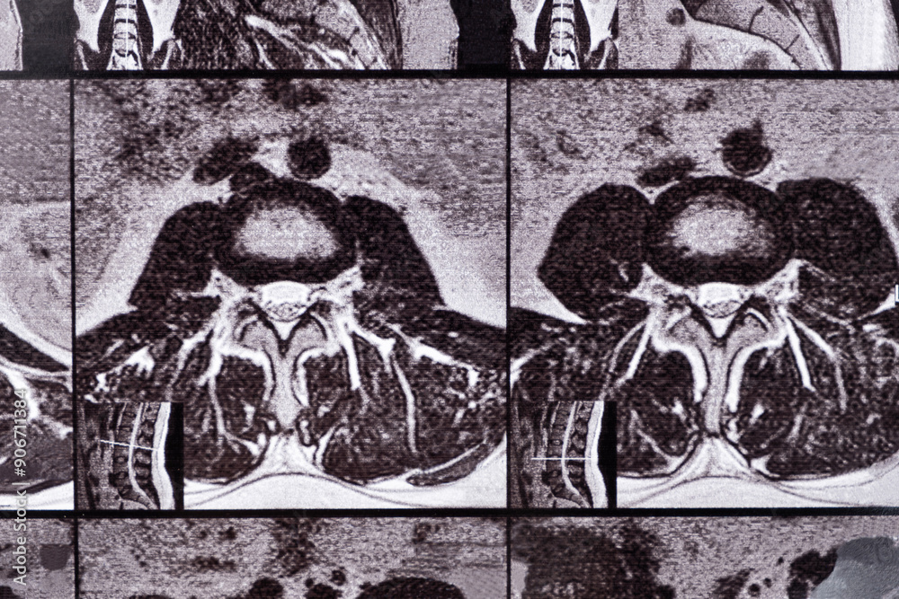 MRI of a patient with intervertebral disc protrusion and ...