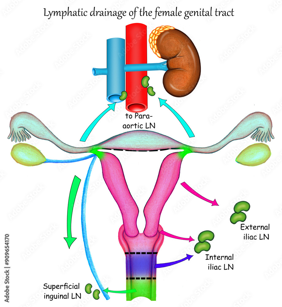Lymph drainage of female genital organs ovary Uterine (fallopian) tubes ...