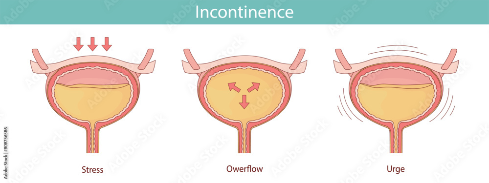 Anatomy of the bladder. Diagram of types of urinary incontinence ...
