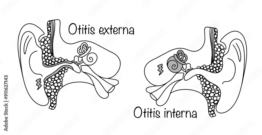 Otitis externa. Otitis Interna Stock Vector | Adobe Stock