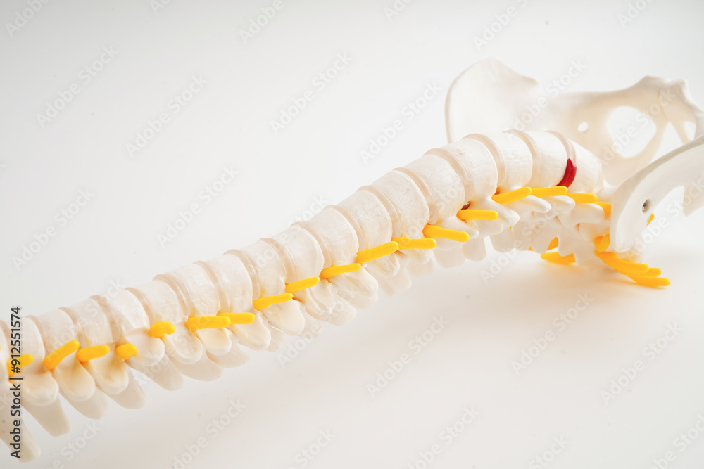 Spinal nerve and bone, Lumbar spine displaced herniated disc fragment ...