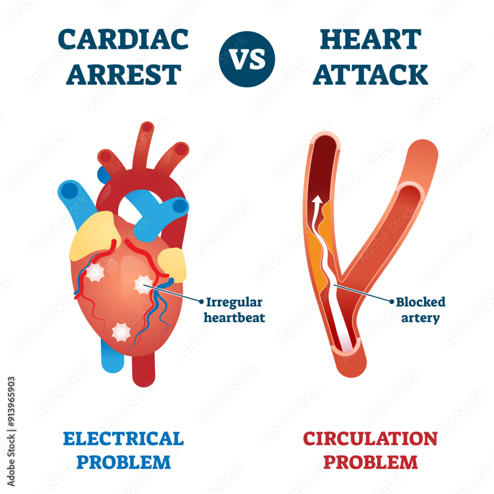 Cardiac arrest vs heart attack illustration, transparent background ...