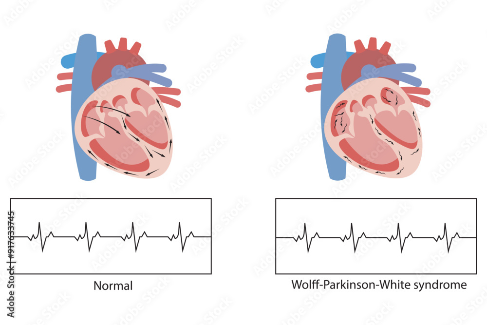 Wolff-Parkinson-White syndrome ,heart condition causing rapid ...