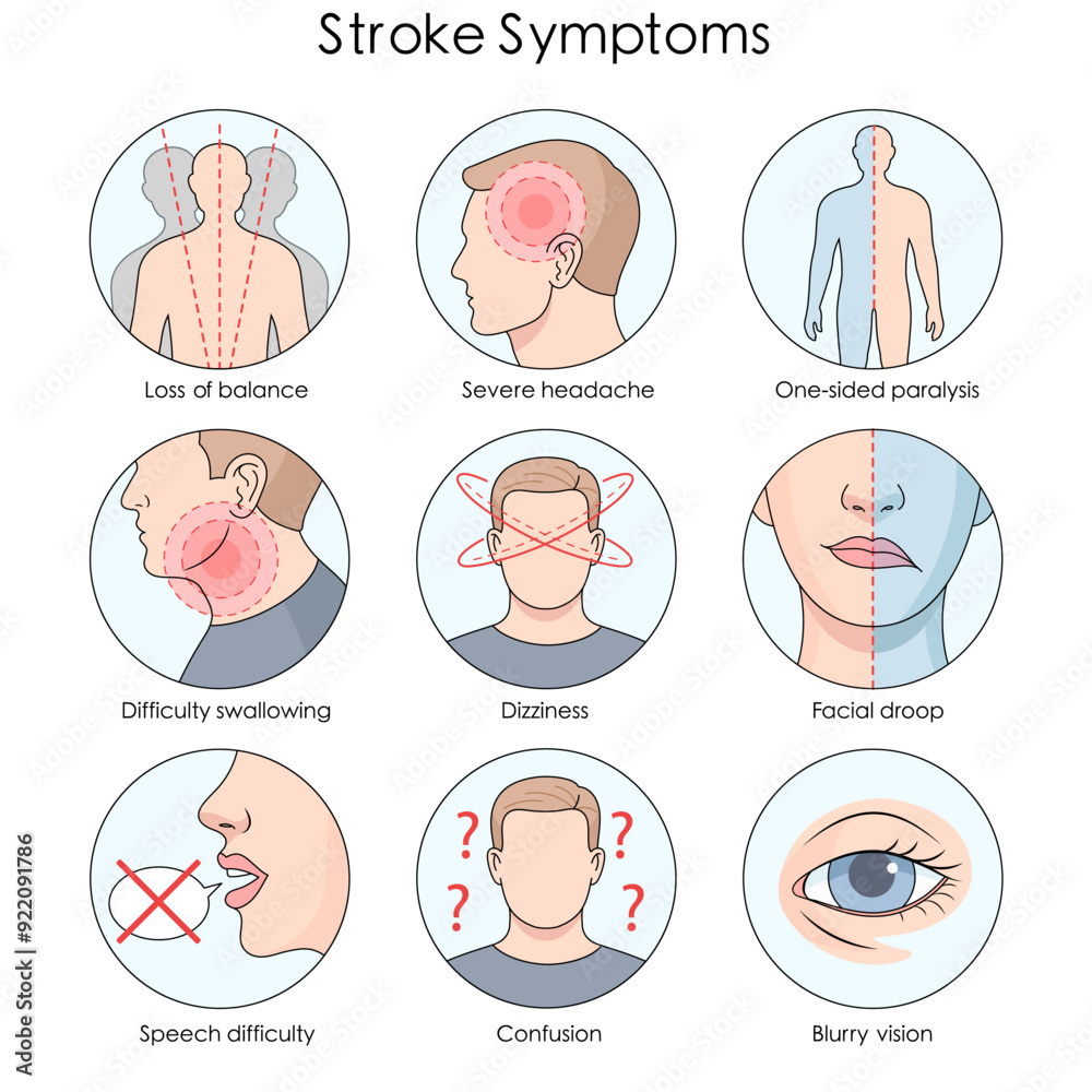 common stroke symptoms, dizziness, severe headache, facial droop, speech difficulty, and one ...