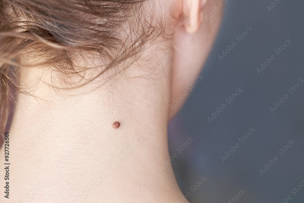 Woman examing her abnormal mole. Dermatology procedure. Doctor checking ...