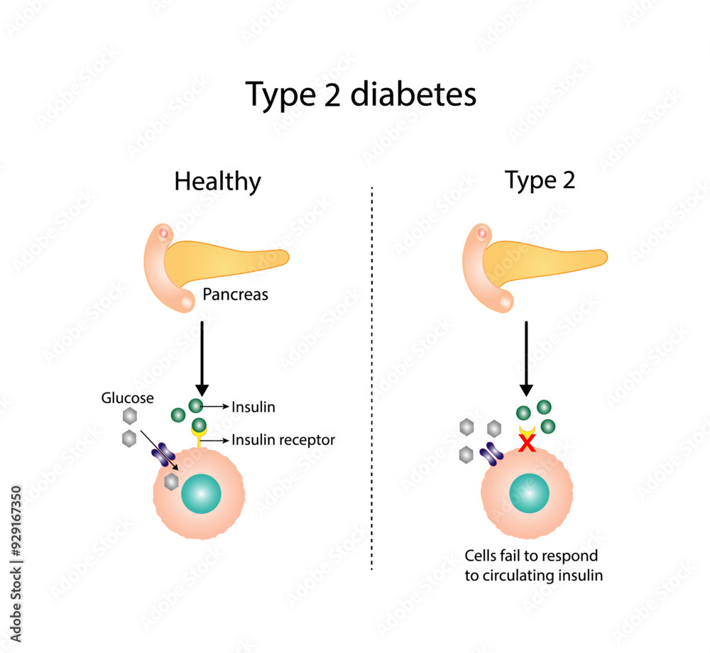 Diabetes mellitus type 2, cells fail to respond to insulin (Insulin ...