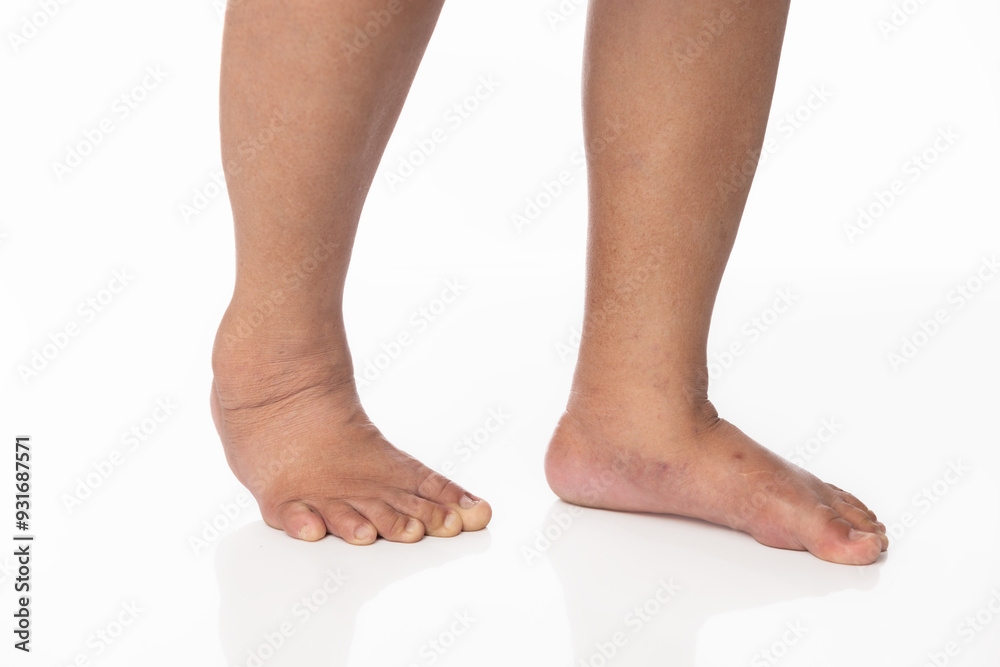 Overweight Senior Women and Ankle Swelling. Stock Photo | Adobe Stock