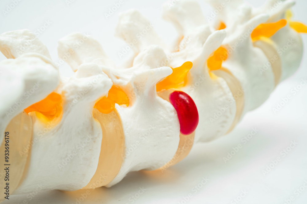 Lumbar spine displaced herniated disc fragment, spinal nerve and bone ...