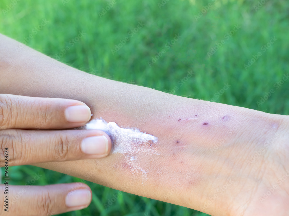 Hand with urticaria allergy itchy rash eczema itch woman from food ...