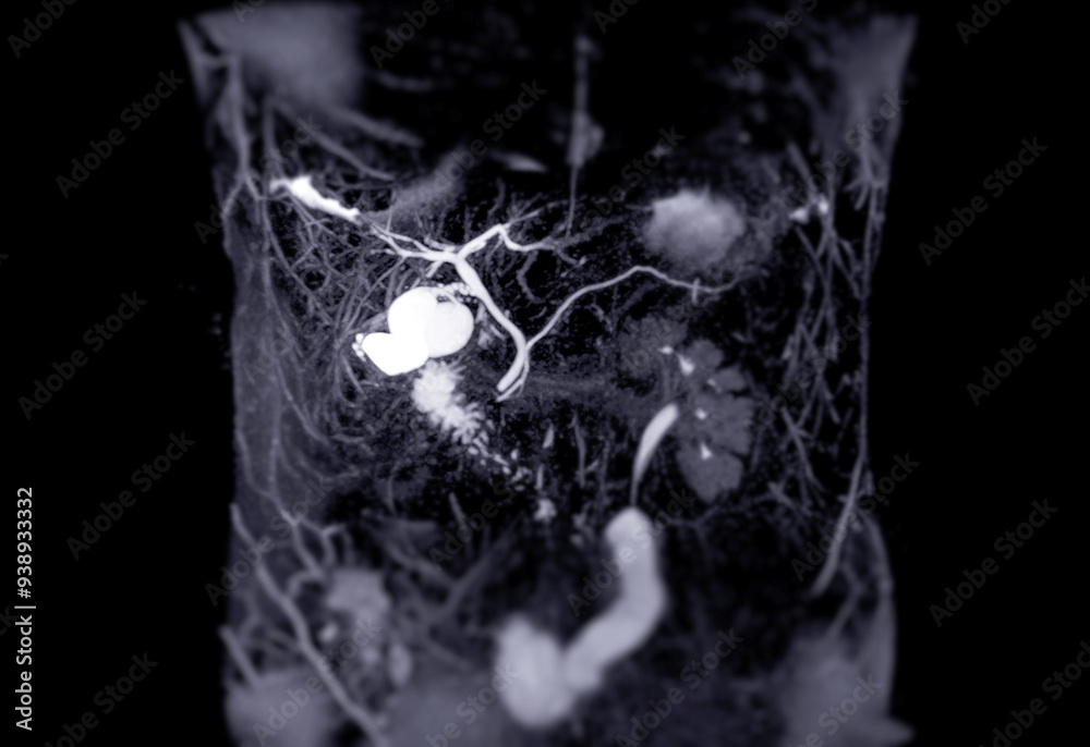 Magnetic resonance cholangiopancreatography or MRCP 3D MIP view showing ...
