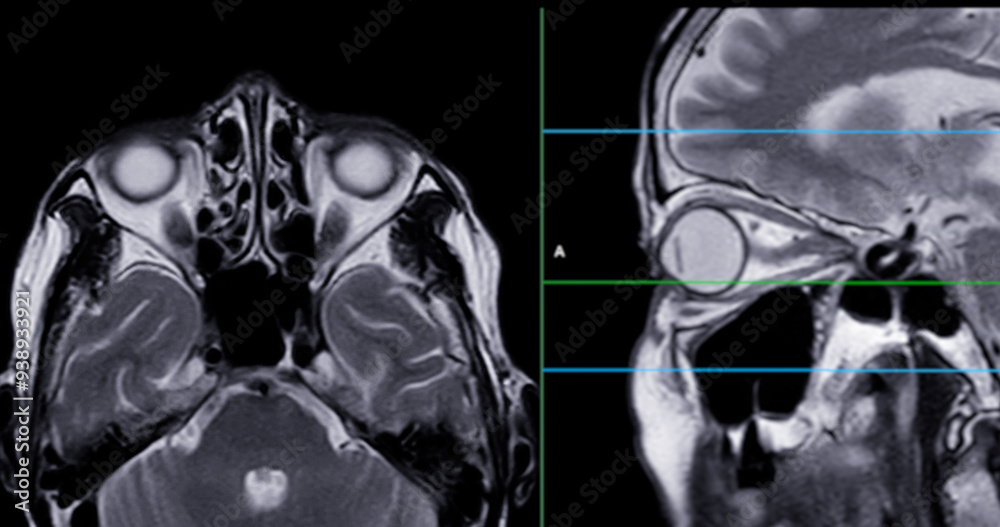 Image of MRI orbit scan with gadolinium contrast in normal case ...