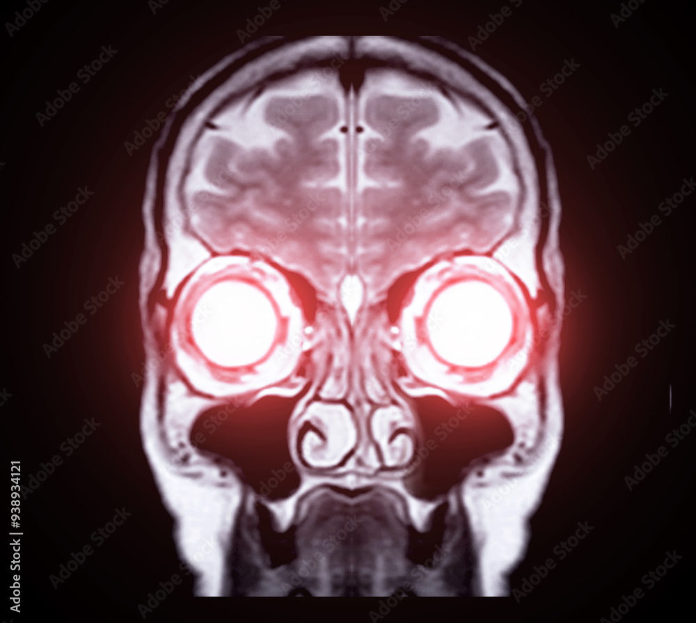 Image of MRI orbit scan with gadolinium contrast in normal case ...