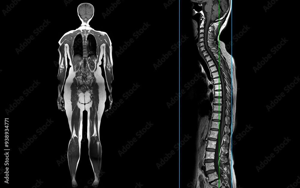 MRI whole body scans are beneficial for early cancer detection ...