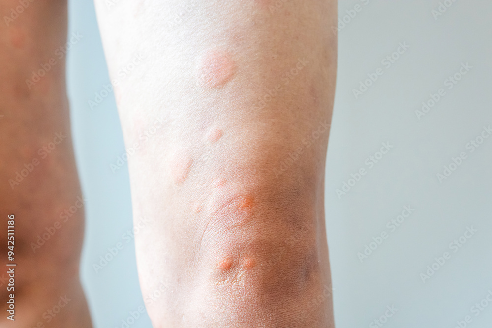 Young asian man has allergic skin rash on his legs from itchy dry skin ...