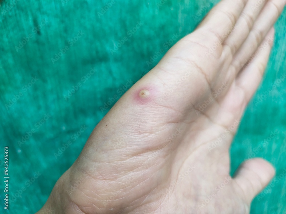 There was one swollen spot on the palm that was infected with a cactus ...