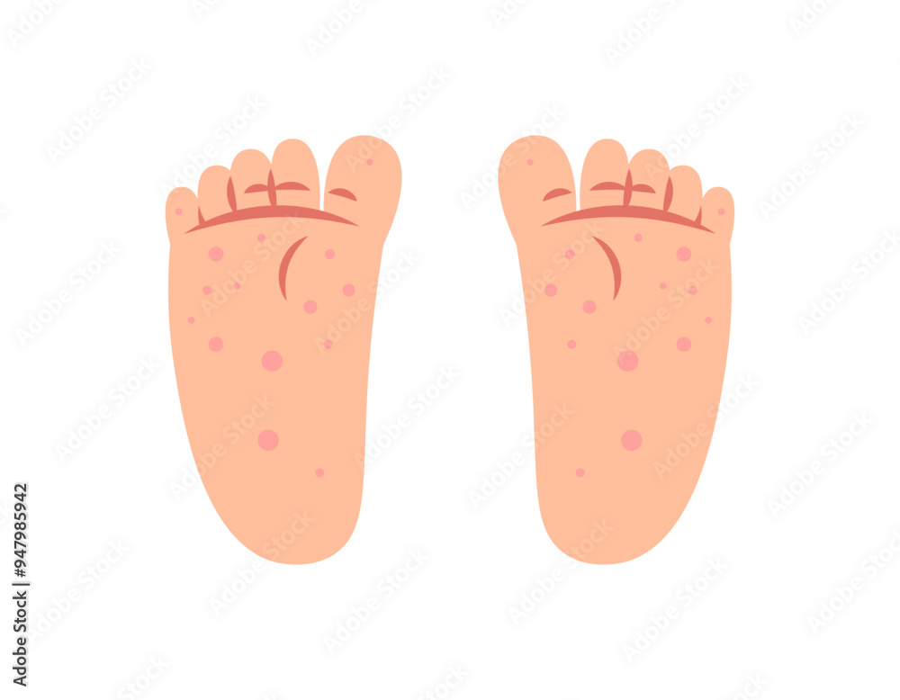 illustration of two soles of feet covered with rashes and wounds. red ...