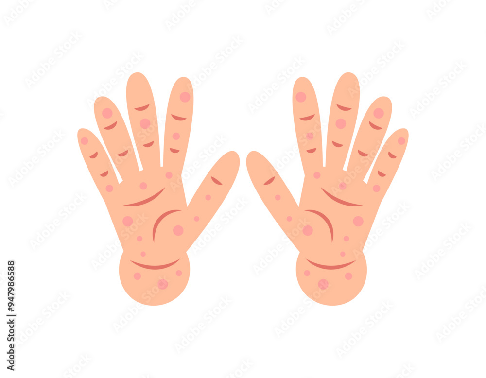 illustration of two palms covered with rashes and wounds. red spots on ...