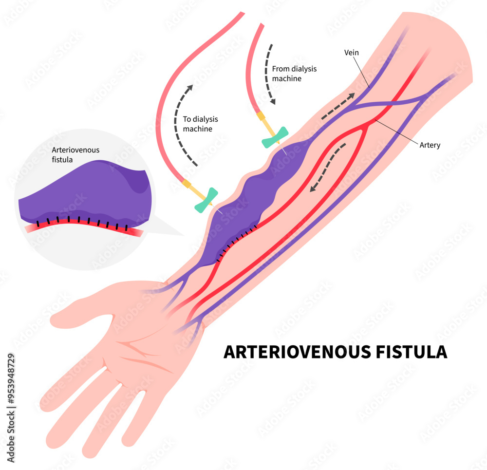 Stock-Vektorgrafik „Blood vessel bypass surgery for kidney disease with ...