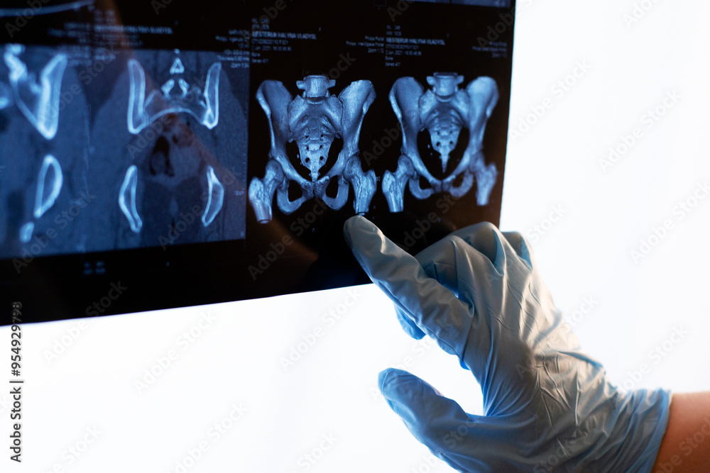 Doctor hand showing Computed tomography image of SI (Sacroiliac) joint ...