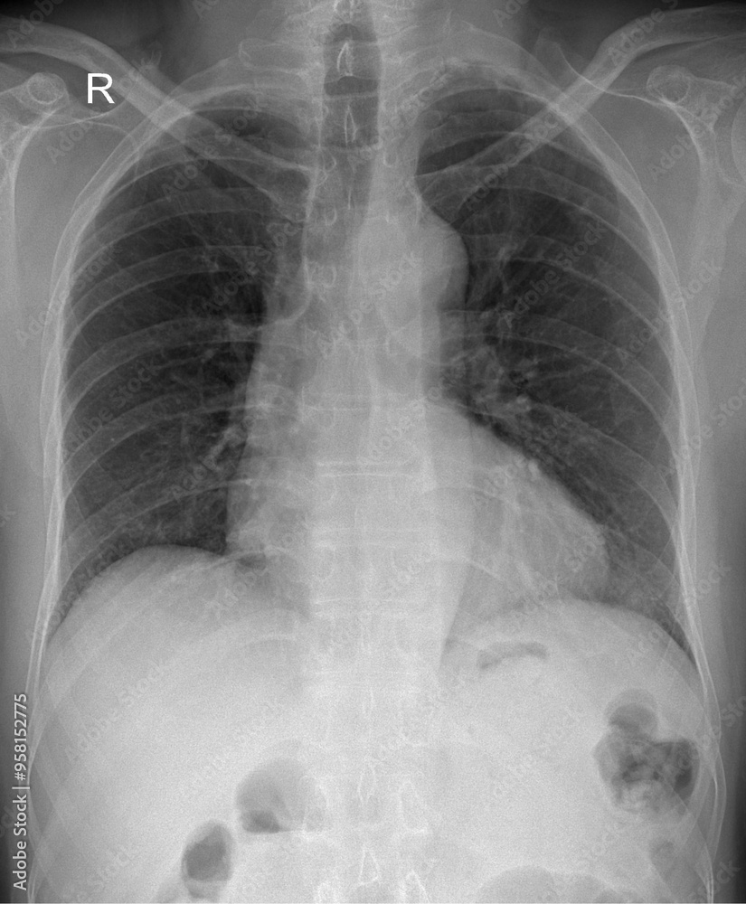 Chest X-Ray: A Radiographic Technique for Evaluating Thoracic ...