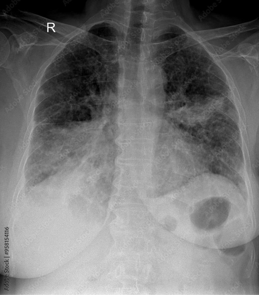 Assessing the Chest Cavity: The Role of Chest X-Ray in Medical Imaging ...