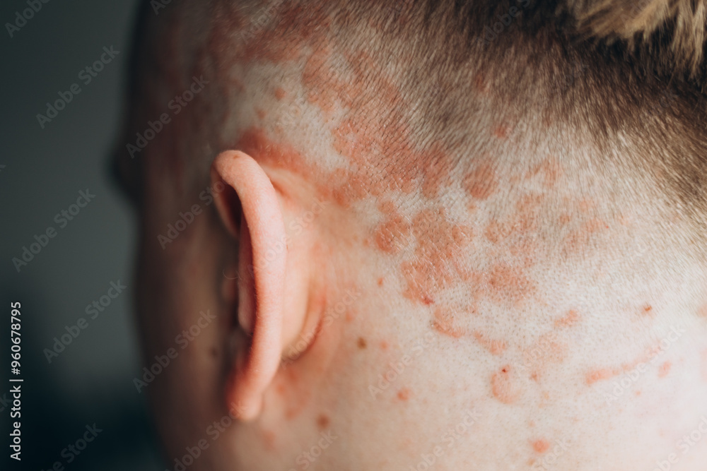 Psoriasis on the skin close-up, scalp, photos of dermatitis and eczema ...