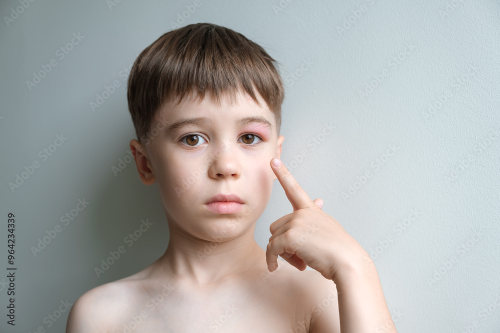 The boy points at his swollen eye from an insect bite. Close-up ...