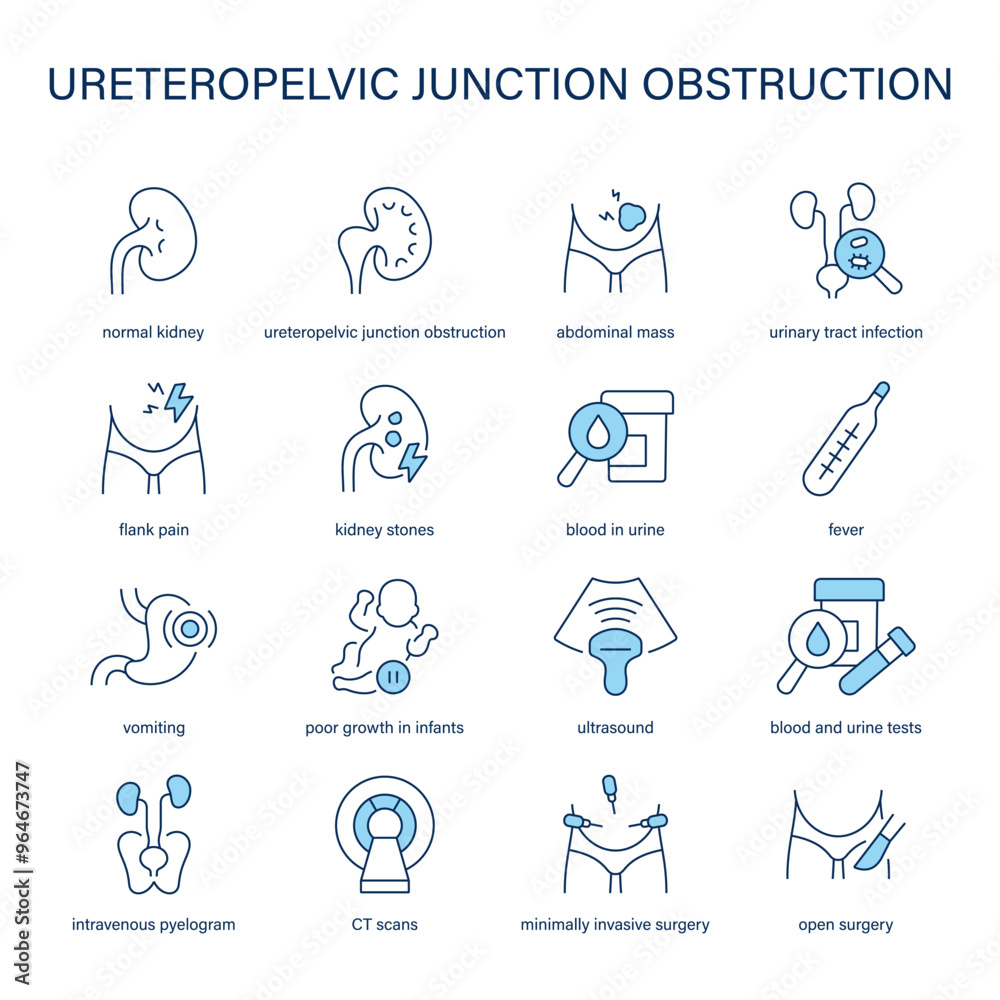 Ureteropelvic Junction Obstruction symptoms, diagnostic and treatment ...
