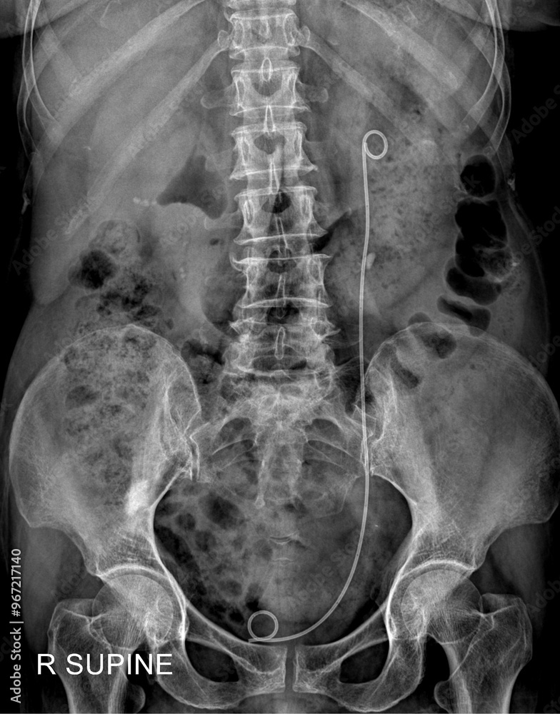 Supine Abdominal X-ray: Identifying Ureteral Stent and Catheters Stock ...