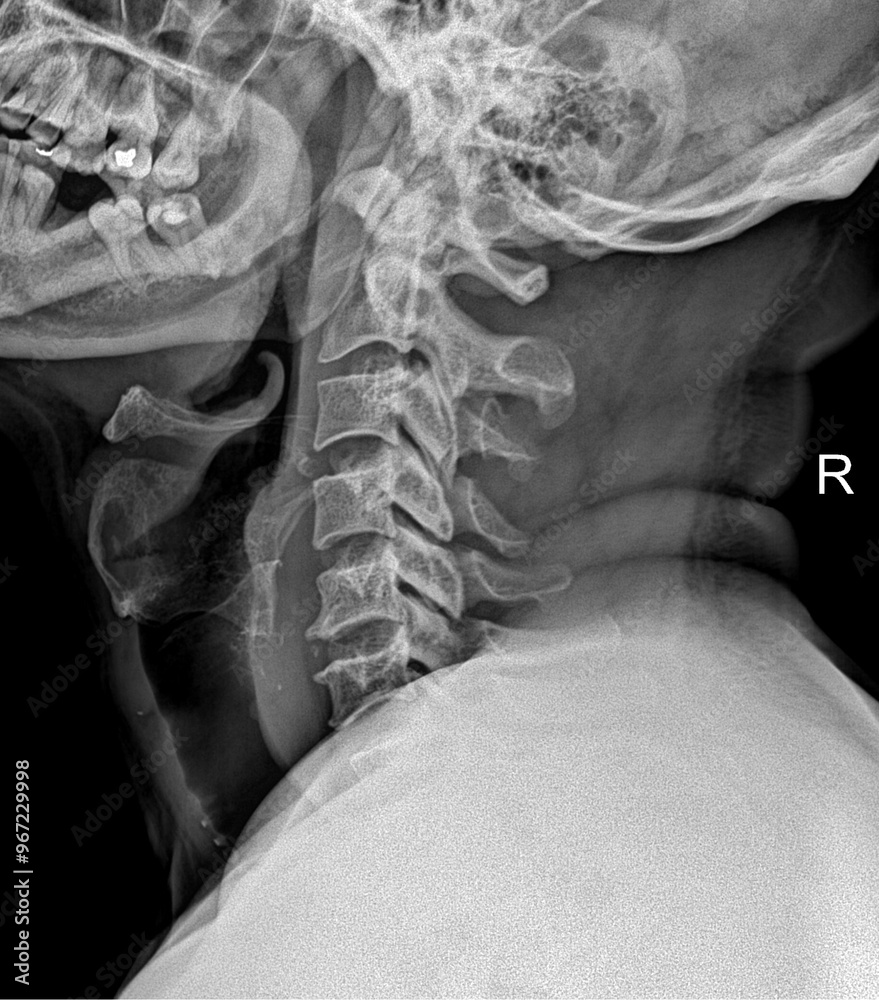 Lateral View X-ray of the Neck: Detailed Imaging of Cervical Spine ...