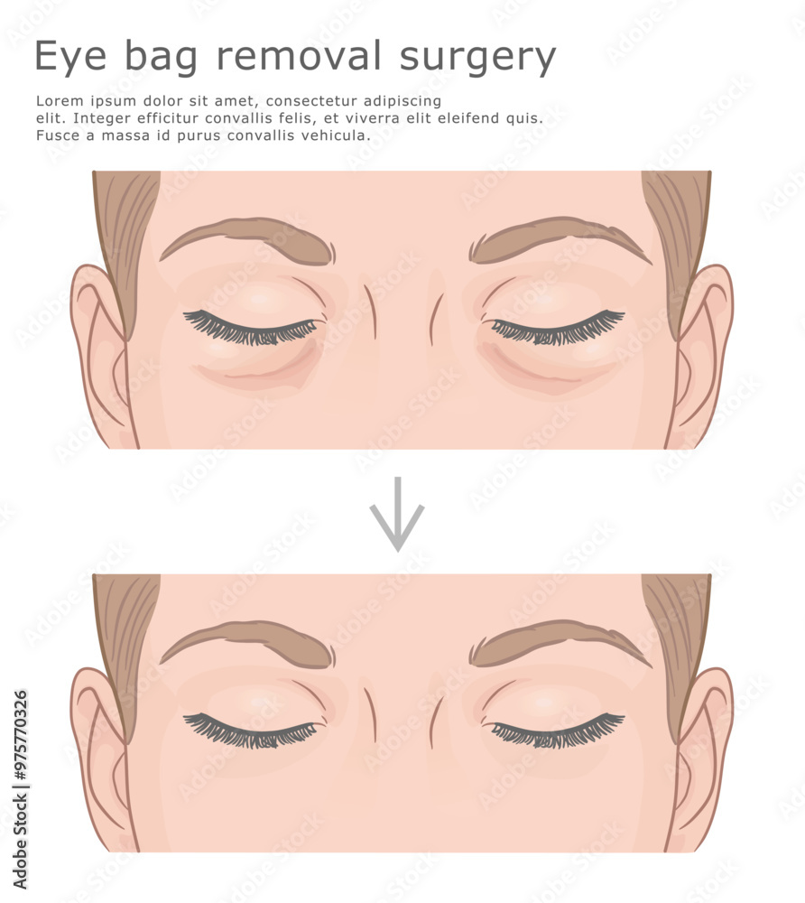 Eye bag removal surgery before and after vector illustration. Facelift ...