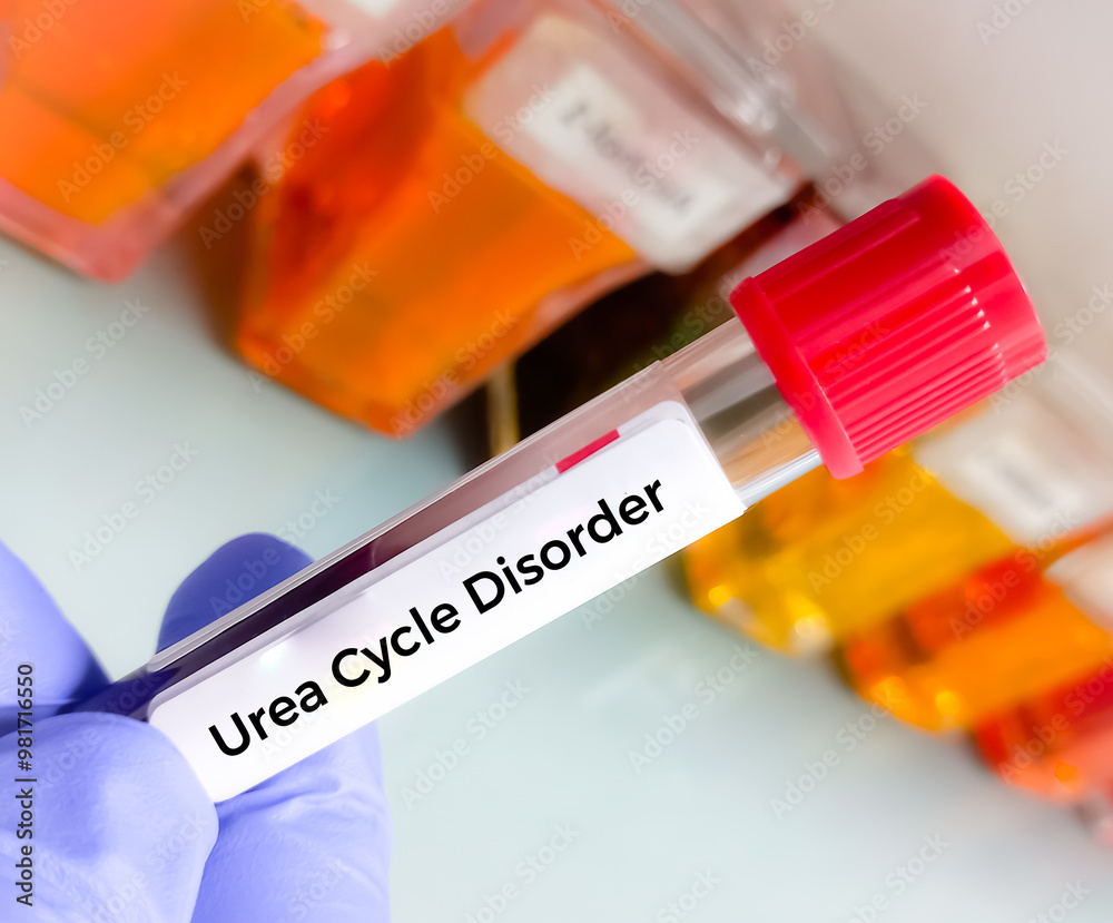 Ammonia level test for the diagnosis of Urea Cycle Disorder (UCD ...