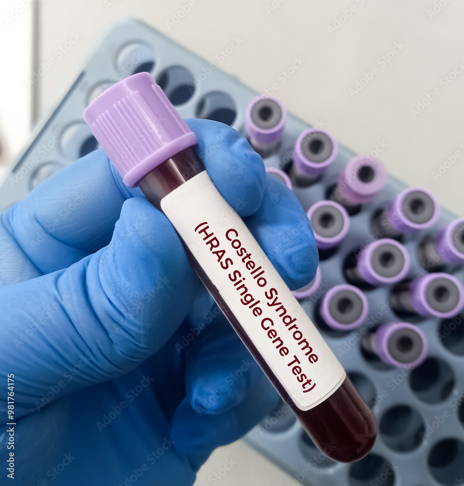 Blood sample for HRAS gene (KRAS and NRAS) test. Costello syndrome ...