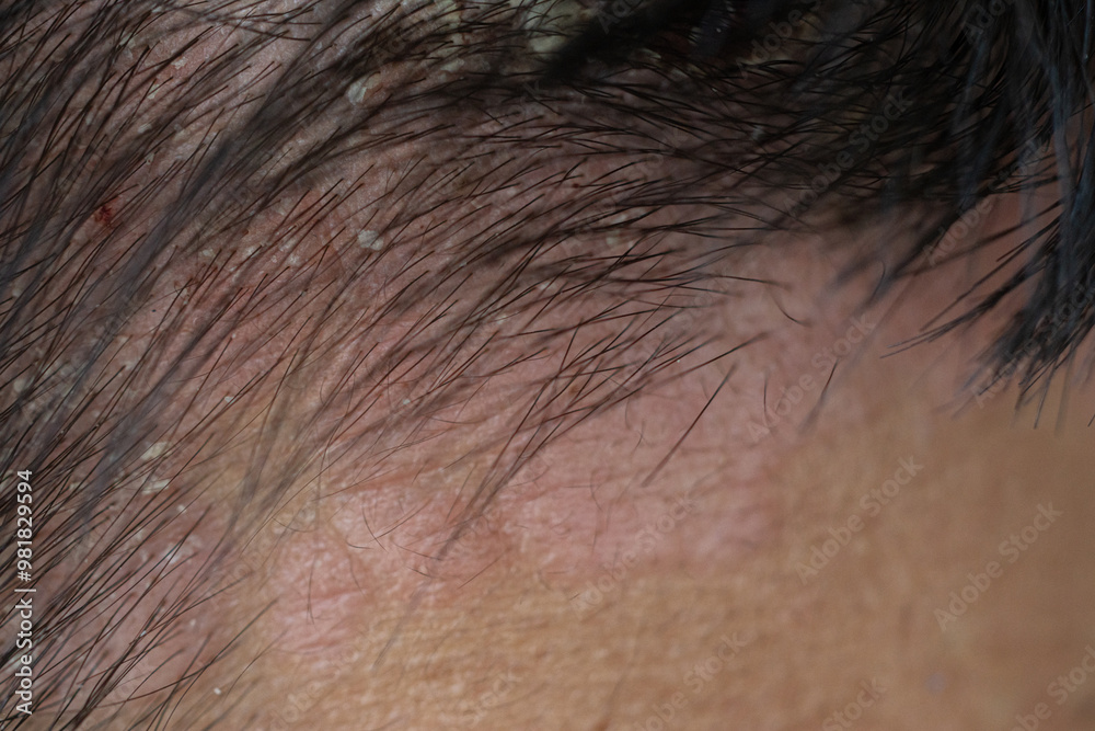 Stock-Foto „Scalp fungal infection that causes skin disease at the head ...