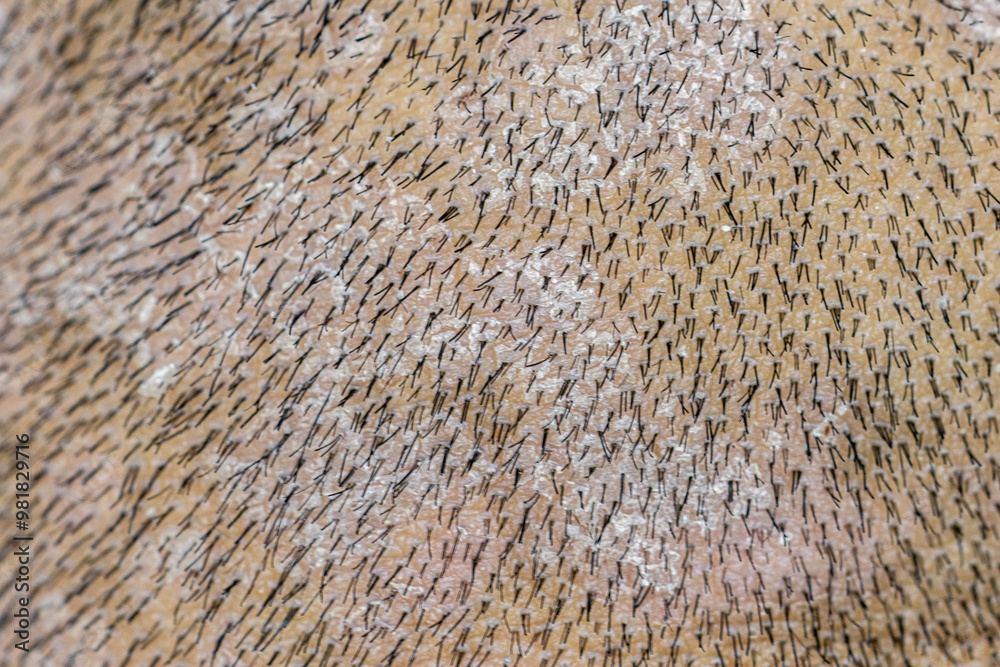 Scalp fungal infection that causes skin disease at the head, skin on ...