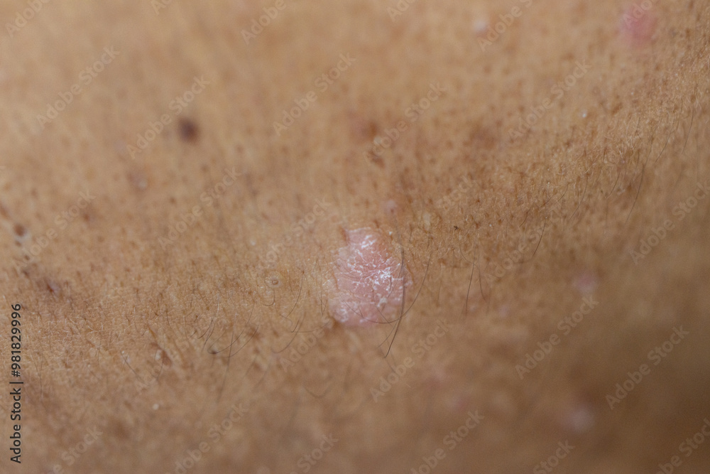 Scalp fungal infection that causes skin disease at the head, skin on ...