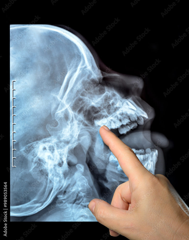 X-ray of a skull of the person. Radiography X ray dislocated jaw broken ...