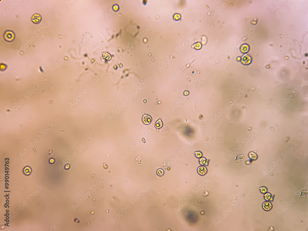 Trichomonas vaginalis in urine sediment analysed by microscope. It's a ...