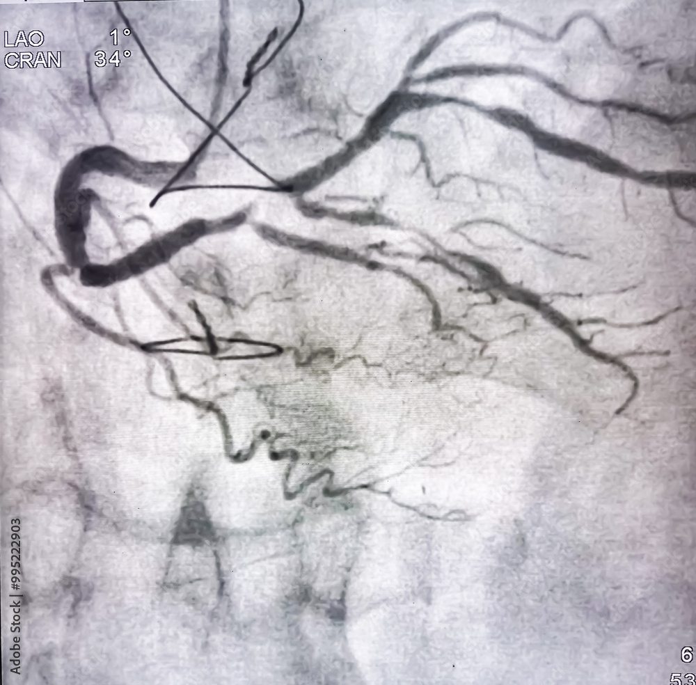 Coronary angiogram after open heart surgury of right coronary artery ...