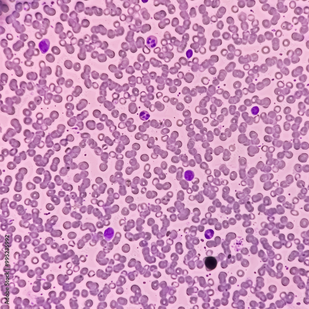 PBF (peripheral blood film): Blood smear thalassemia showing hypochromia,schistocyte,NRC,Target ...