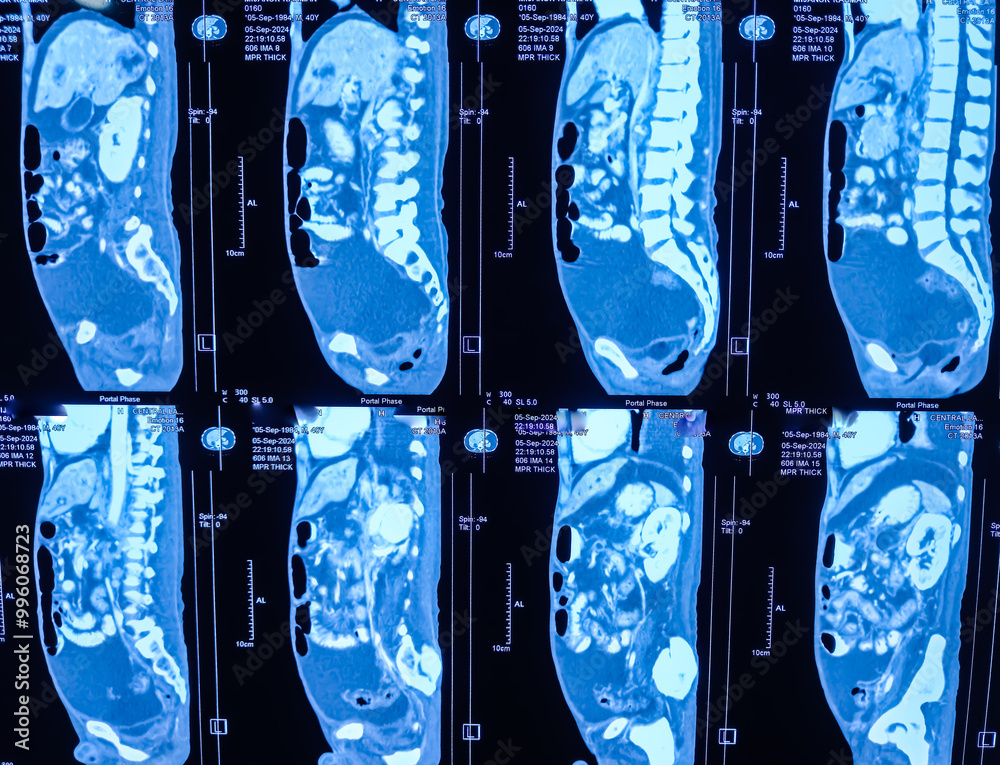 Image show CT whole abdomen with contrast. Findings huge ascites ...