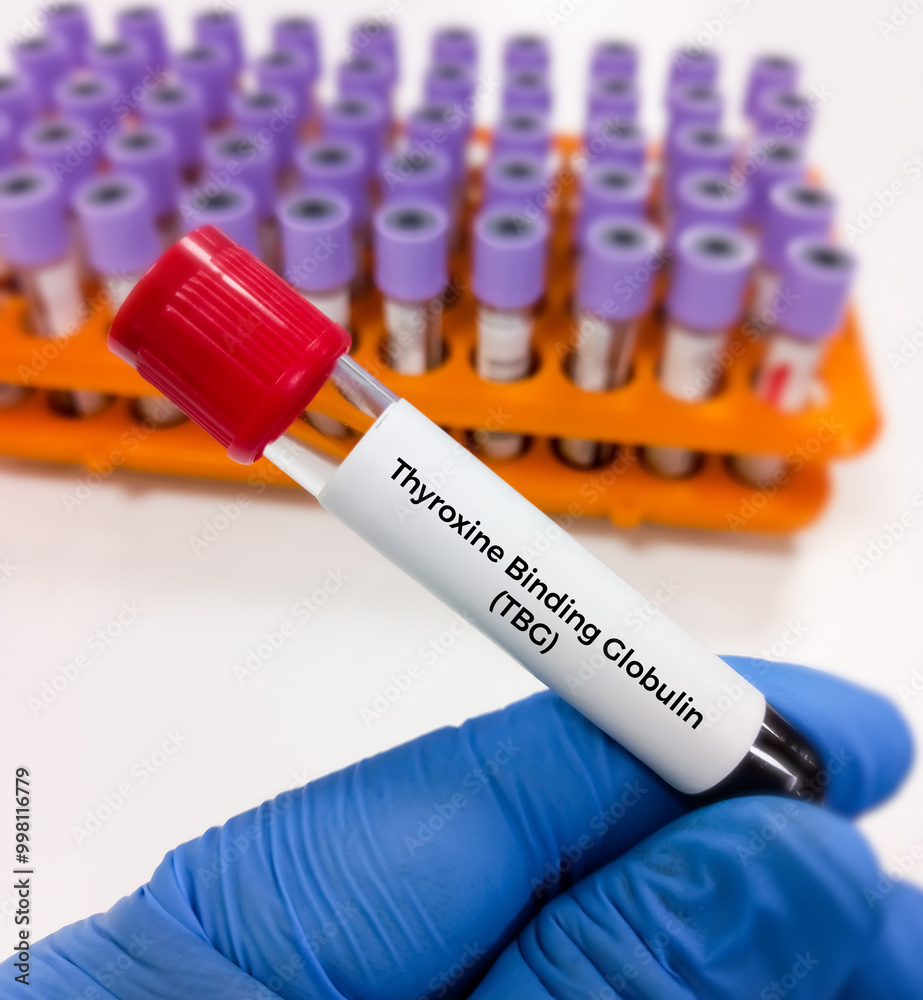 Blood sample for TBG (Thyroxine-binding globulin) test. Thyroid ...