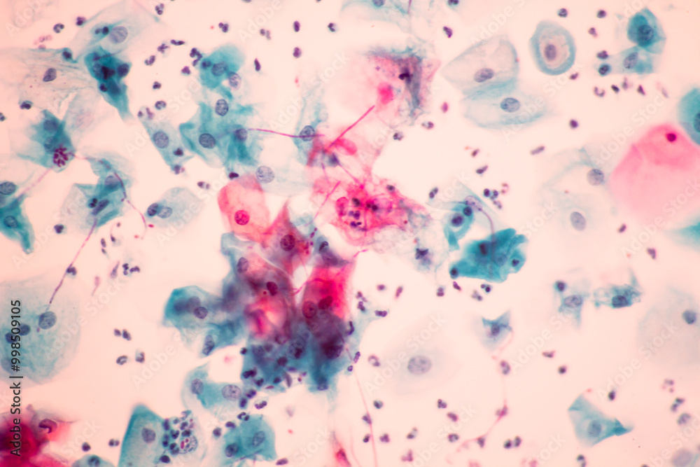 View in microscopic of Candidiasis, fungus infection (Yeast and ...