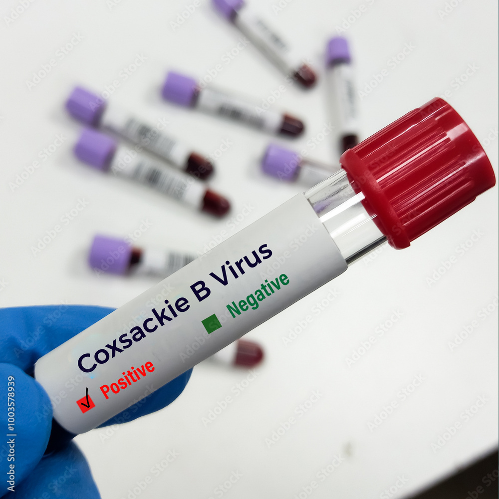 Blood sample for Hand foot and mouth disease (HFMD) test. It is a ...