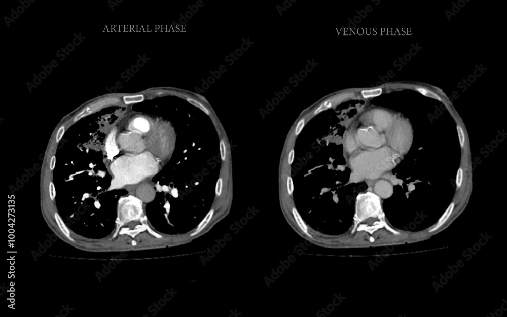 A CT scan of the chest showing multiple cross-sectional views ...