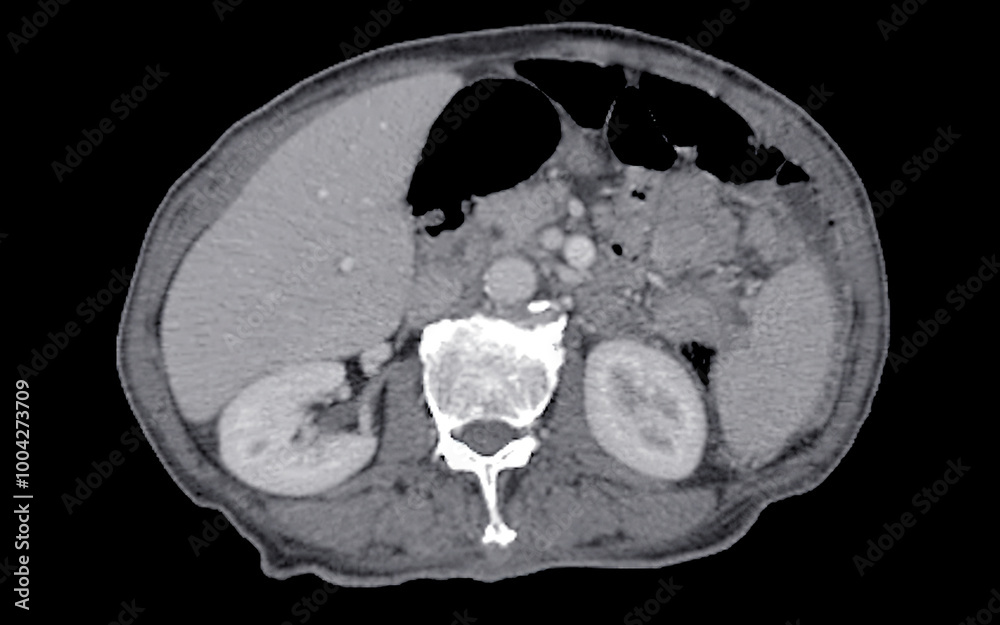 A normal CT scan of the upper abdomen, showing clear and healthy cross ...