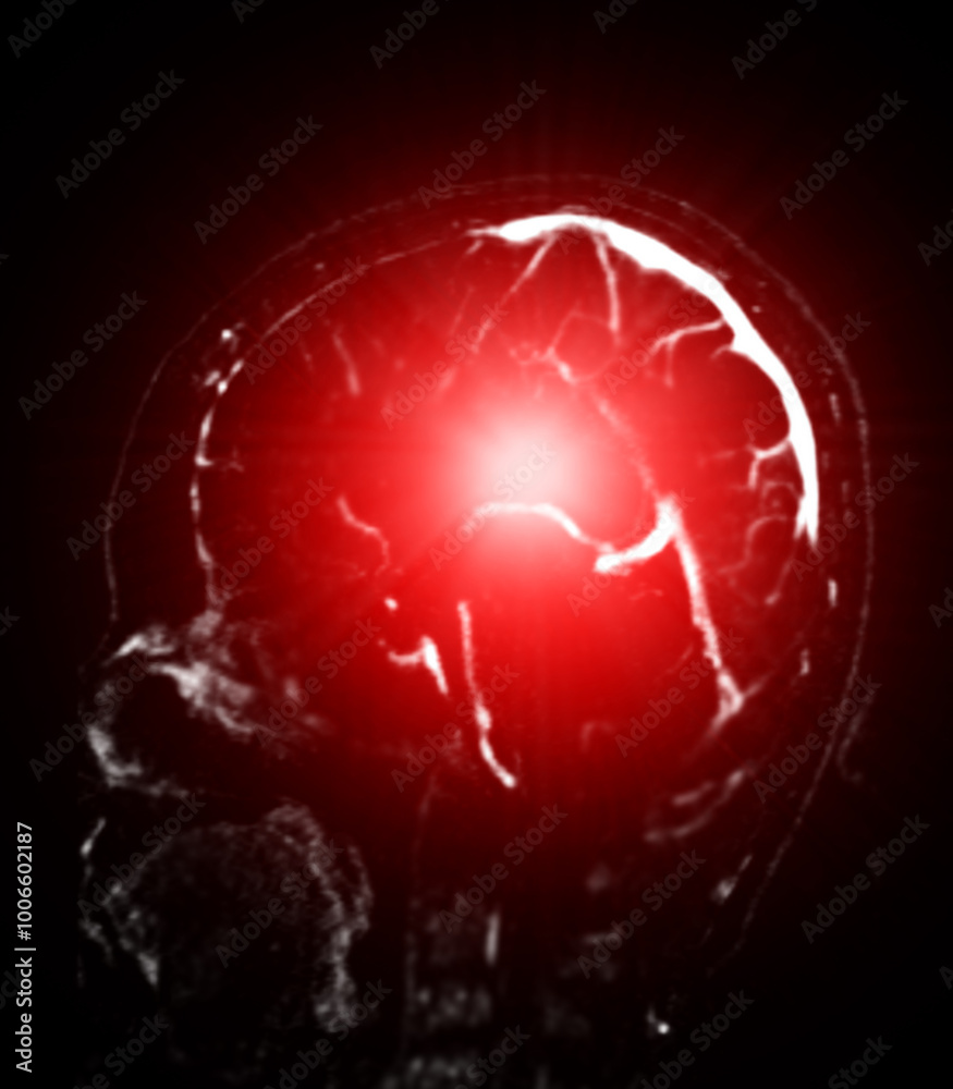 A normal MRV brain scan showing clear and healthy venous structures ...